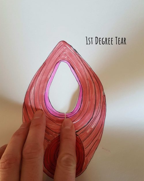 Vaginal Tears In Childbirth – What You Need to Know - ReConnect Health ...